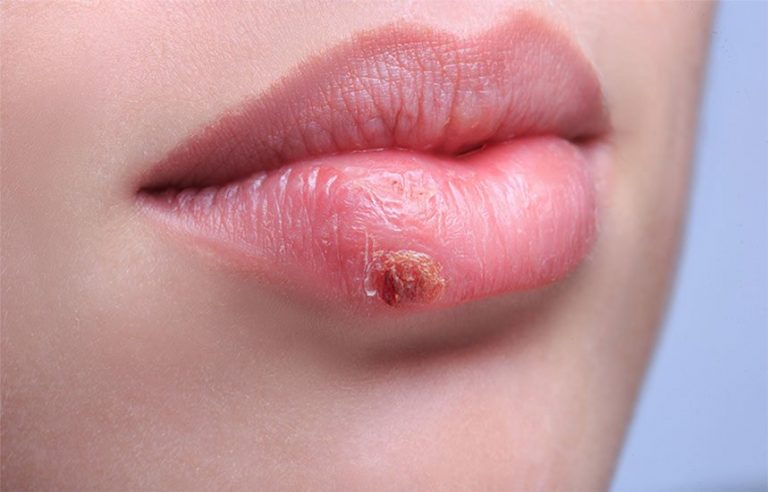 Cold Sores: Symptoms, Diagnosis and Treatment – Health Articles Magazine